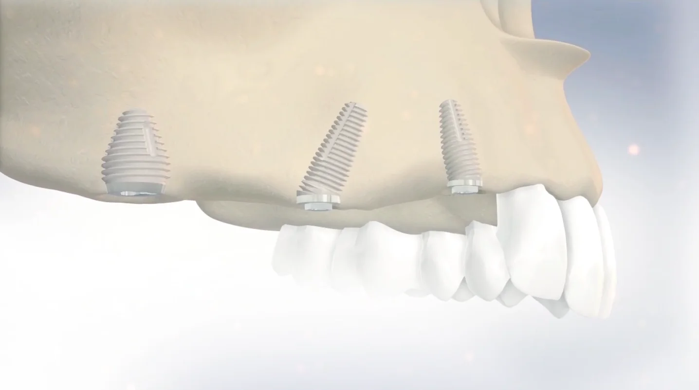 Implanturi Co-Axis® Southern Implants în România